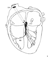 Supraventricular Tachycardia Overview (SVT, PSVT) - Experts for ...