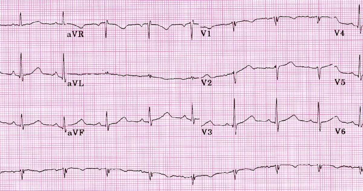 Study Medical Photos QT Interval Prolongation On ECG study-medical-photos-qt-interval-prolongation-on-ecg