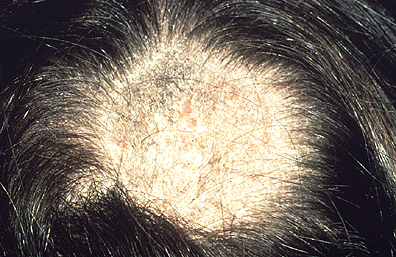 Dermatitis seborreica