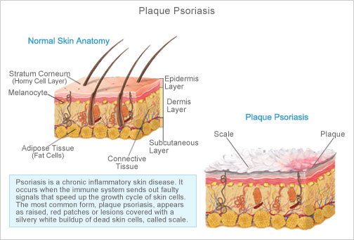 Psoriasis Natural Treatment BLOG: Five Main Types of Psoriasis