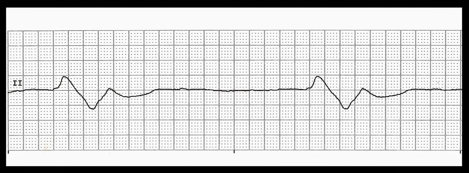 Various Agonal Rhythms