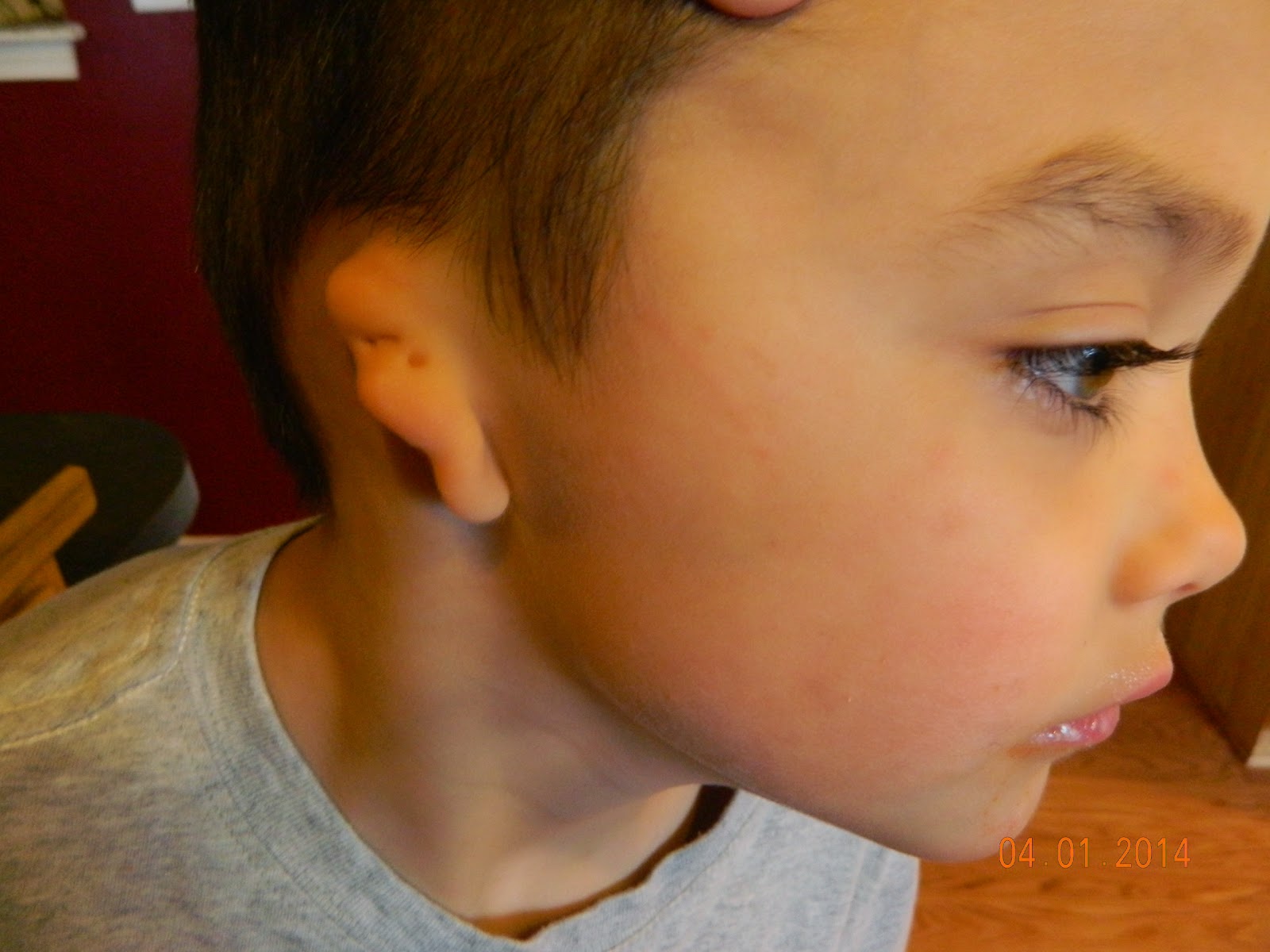 Microtia: Microtia Rib Cartliage Ear Surgery done in only ONE surgery!