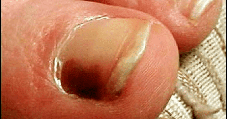 Toenail Cancer Symptoms - What is Cancer