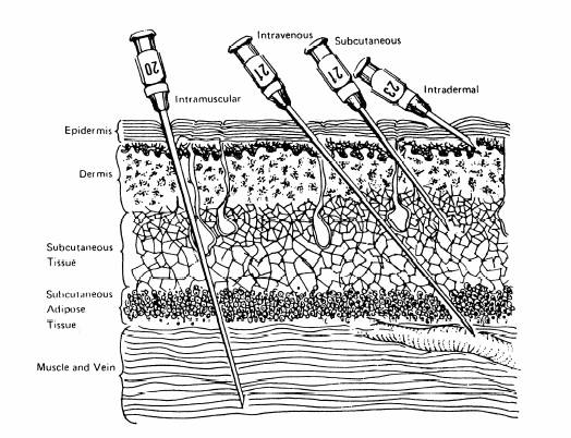 suntik putih: 4 Macam Cara dan Teknik Penyuntikan