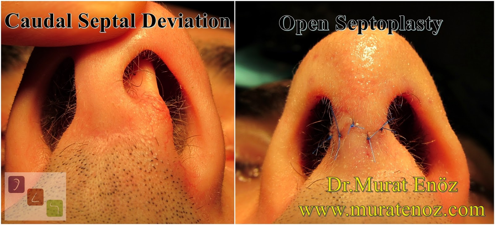 Correcting The Deviated Septum