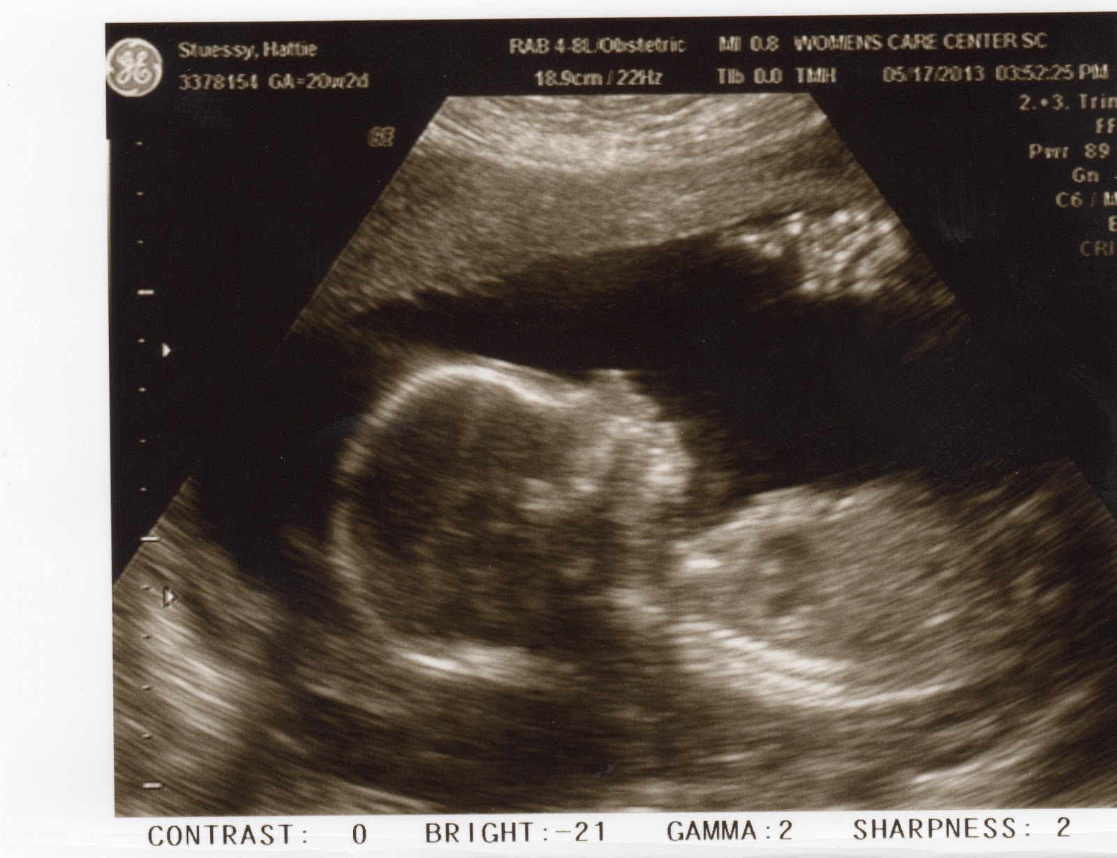 Life of Hattie: Week 22 - It's a baby girl!