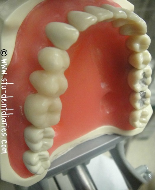 Stu-DENT Diaries: The Making of a Three Unit Bridge 1