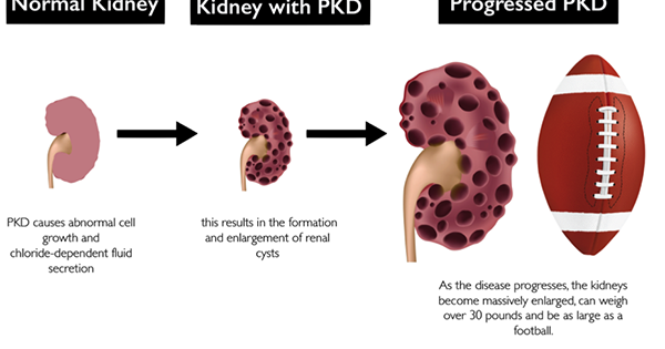 treatment for kidney disease: Stages of Polycystic Kidney Disease (PKD)