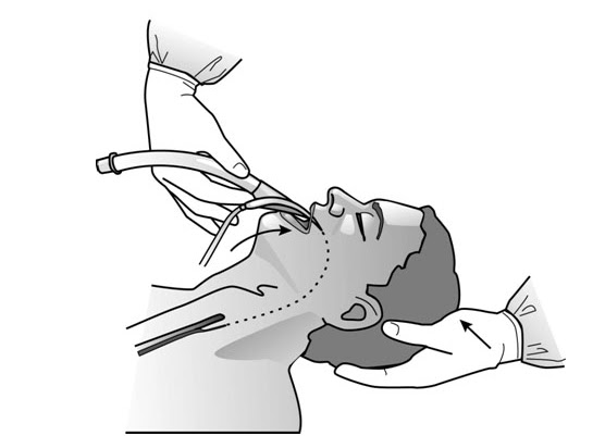 EM Girl: How to insert an LMA