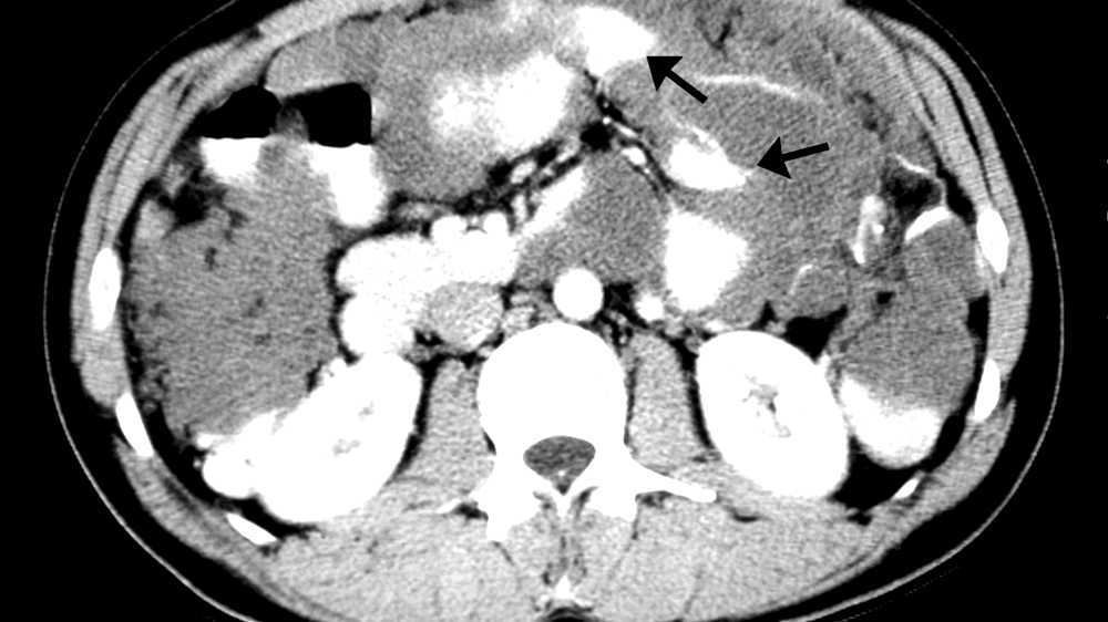 Pseudomyxoma peritonei