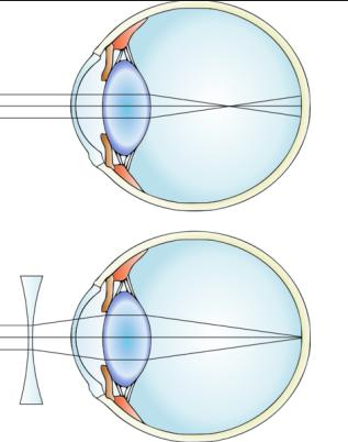 Ciri-Ciri Mata Rabun Dekat dan Rabun Jauh