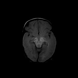 IRRADIATED - Radiology: Maple Syrup Urine Disease (MSUD)