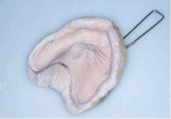 Non Elastic Impression Materials-Prosthetic Dentistry Lecture Note ...