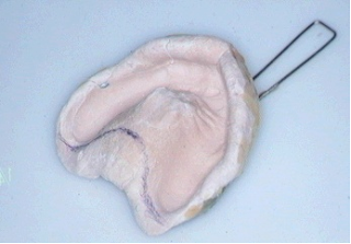 Dentistry and Medicine: Non Elastic Impression Materials-Prosthetic ...