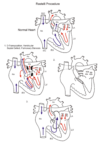 Rastelli Procedure ~ Cardiovascular Nurse