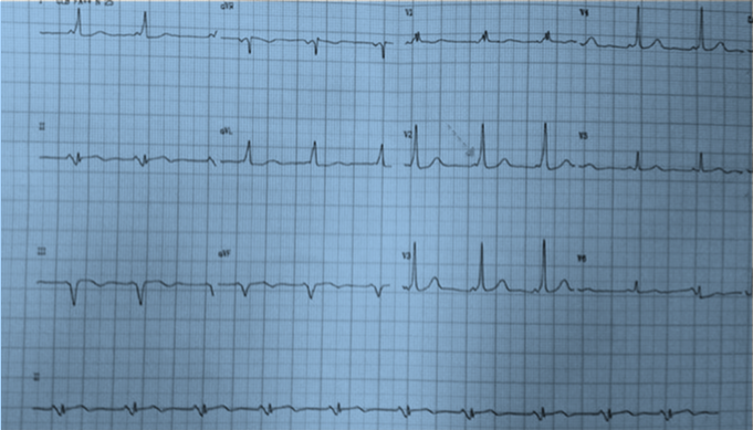 Blog de Eletrocardiografia: PRÉ-EXCITAÇÃO VENTRICULAR E TAQUIARRITMIAS ...