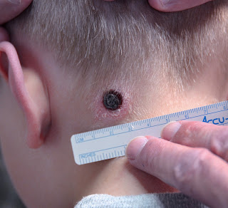 VIRTUAL GRAND ROUNDS IN DERMATOLOGY 2.0: Innoculation Eschar