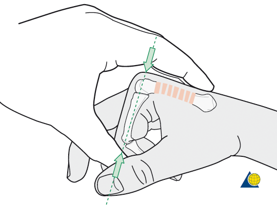 Trick of the Trade: Reducing the metacarpal fracture | little white coats
