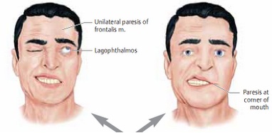 Mengenal Gejala Stroke di Usia Muda - Petunjuk Onlene