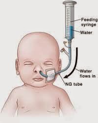 Nasogastric Feeding or Gavage Feeding ~ Nursing Path