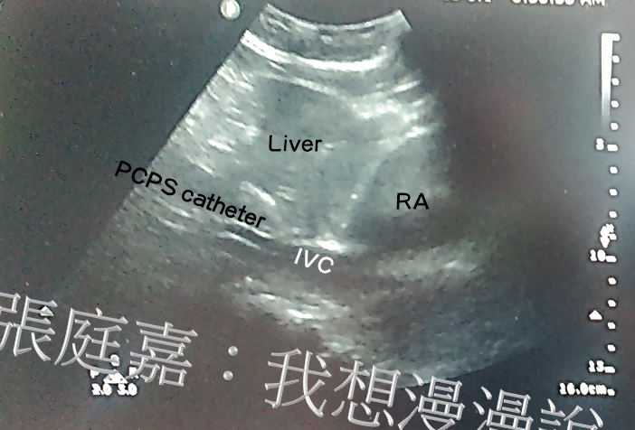 心臟超音波：IVC看甚麼？之一