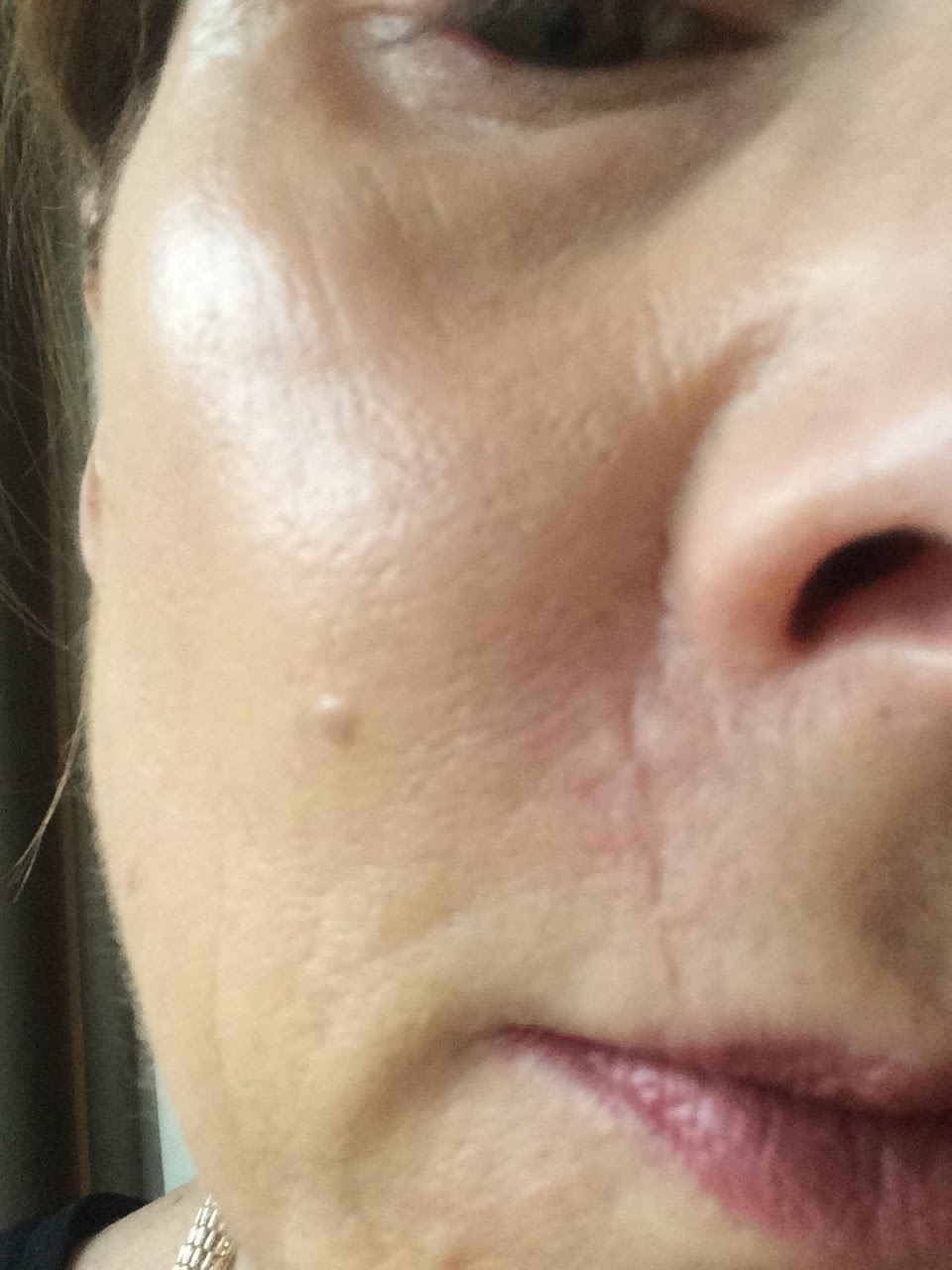 BraveFace . Diary of a facial basal cell carcinoma ( bcc): 2017
