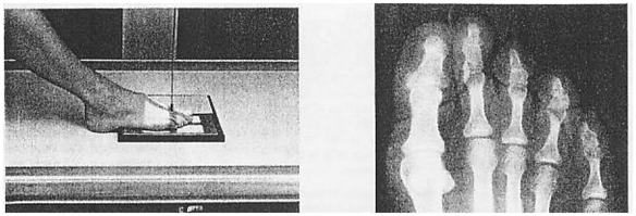 Teknik Radiograf: Teknik Radiografi Pedis pada kasus Fisura pada phalanges