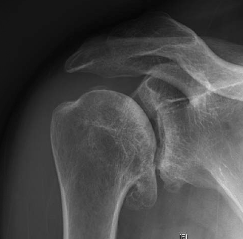 UW Shoulder and Elbow Academy: Is there an advantage in partial humeral ...
