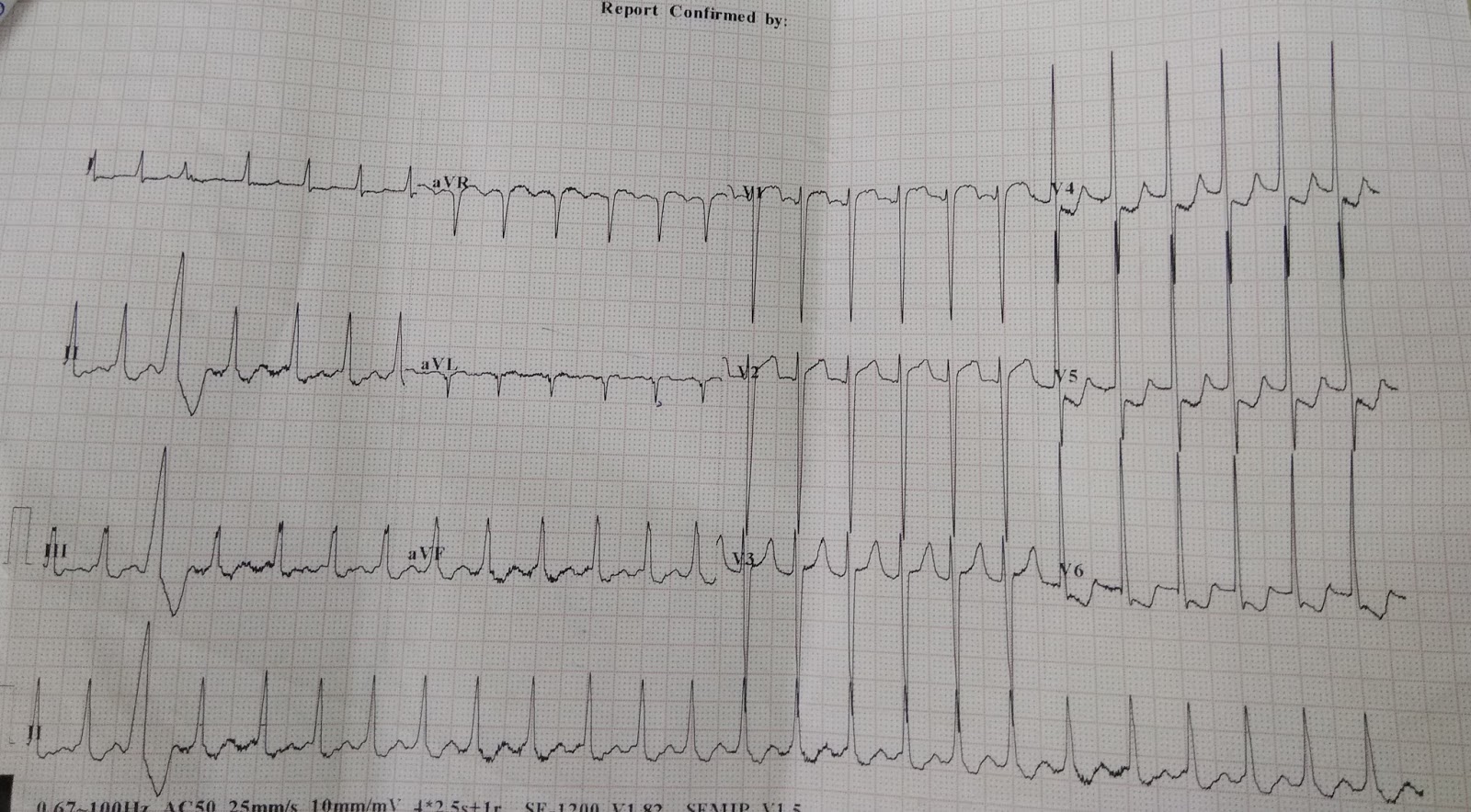 Cardiology window: Atrial flutter