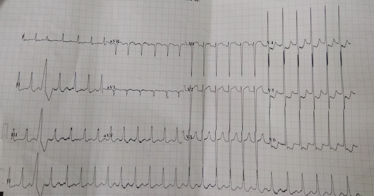 Cardiology window: Atrial flutter