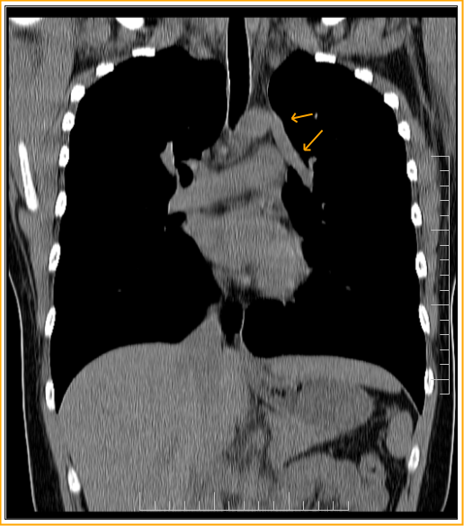 Partial Anomalous Left Upper Lobe Pulmonary Venous Drainage - Sumer's ...