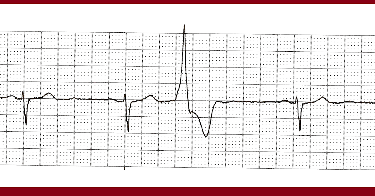 Float Nurse: Various Trigeminal PVCs