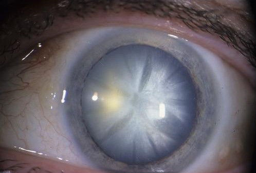 Deformutilation: Cataracts