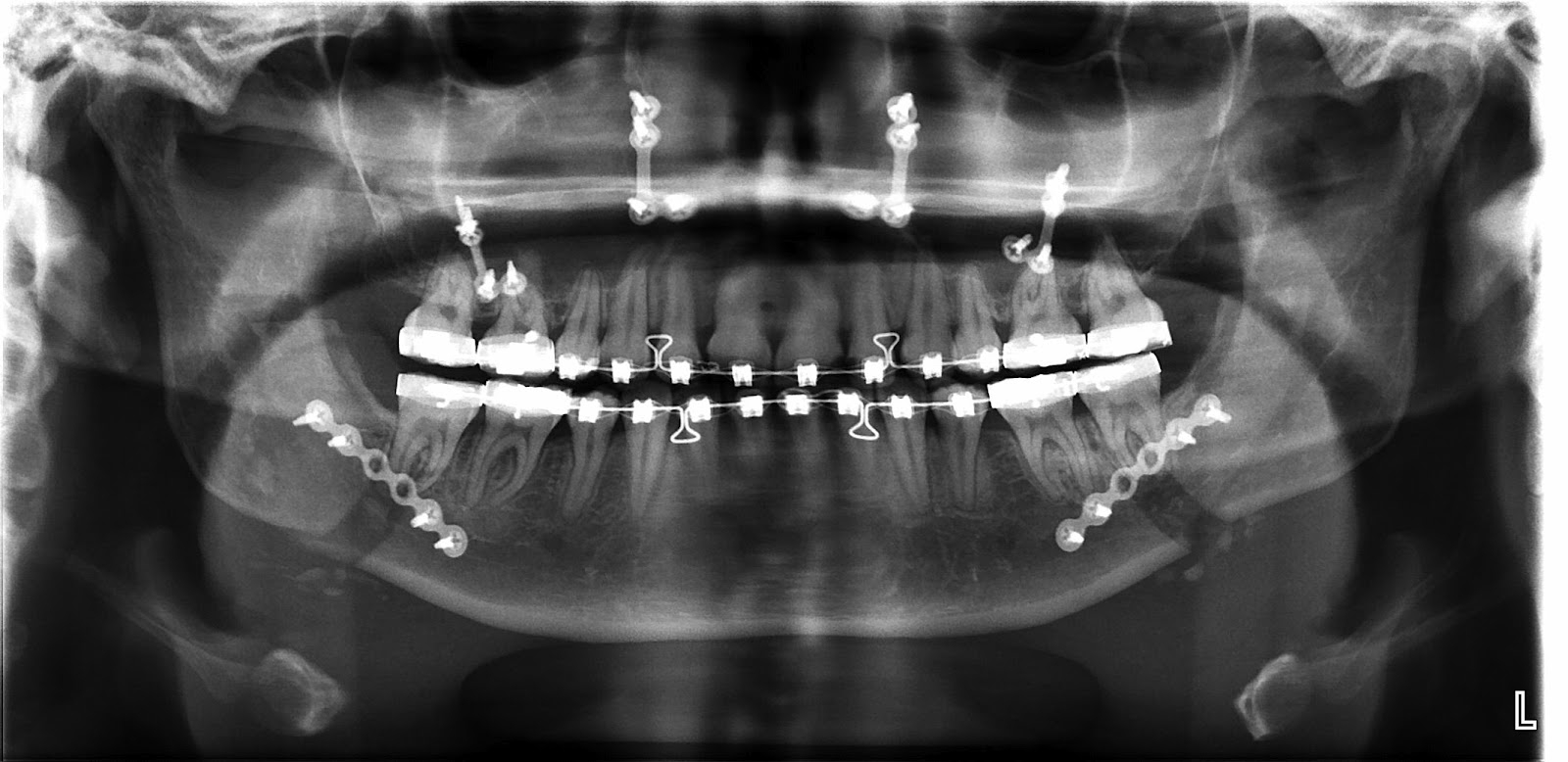 Cindy's kaakoperatie: Week 8 (dag 51 t/m 57) na de operatie + röntgenfoto