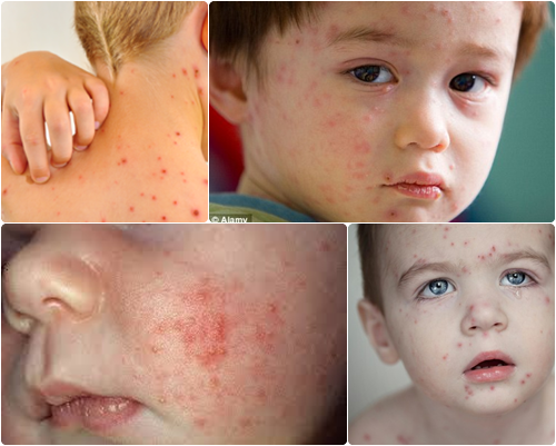 Cara Mengobati Gabagen Pada Anak Terbukti Ampuh Dan Aman | Cara ...