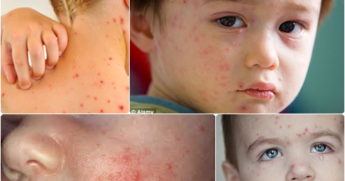 Cara Mengobati Gabagen Pada Anak Terbukti Ampuh Dan Aman | Cara ...