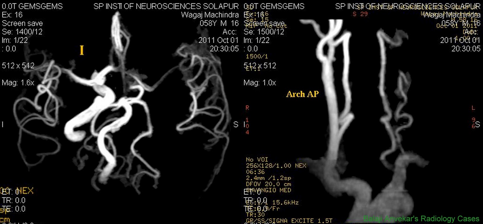 Dr Balaji Anvekar FRCR: ICA Unilateral Congenital Absence