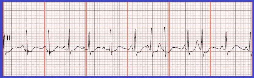 Basic EKG Rhythm Test 12