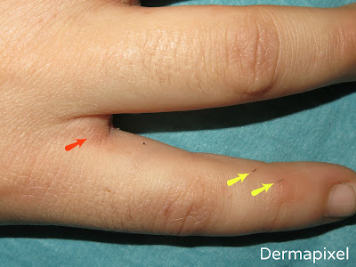 Dermapixel: junio 2017