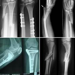 TAKAFUL & HIBAH. FOR ALL FOR LIFE: Kes Patah Tulang & Pemasangan Besi