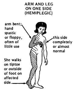 stimr.com: Hemiplegia & the OT role
