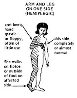 stimr.com: Hemiplegia & the OT role