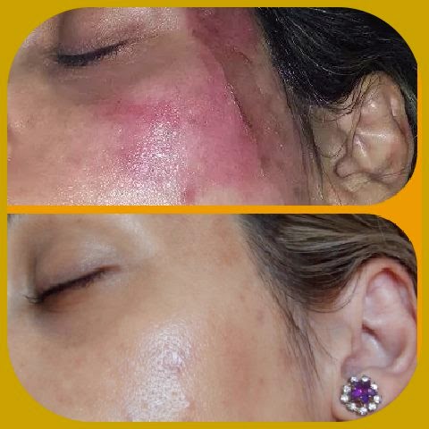 Rosane Menezes, Saúde e beleza.: Tratamento de queimadura ( SESSÕES )