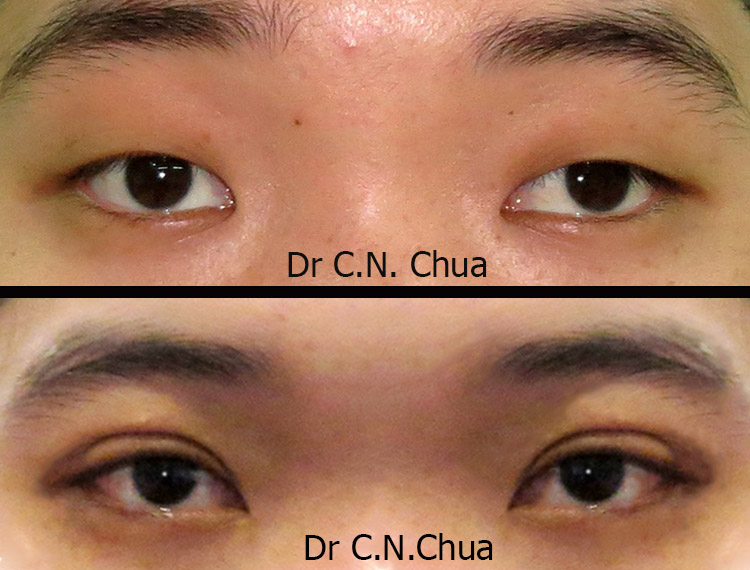 Eyelid Surgery by Prof Dr CN CHUA 蔡鐘能: Doc, Can You Straighten My Eye? II