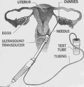 Reproductively Challenged: Egg Retrieval Process & My Procedure