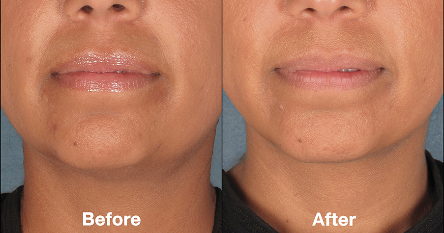 Shop Suddenly Slimmer : Please explain the results of Kybella. How many ...