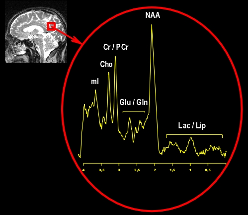 MRI& CT Signs: Normal MRS