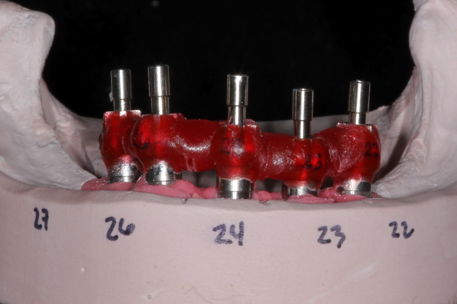 Boise Idaho Prosthodontics: Intra-oral Luting of Implant Verification ...