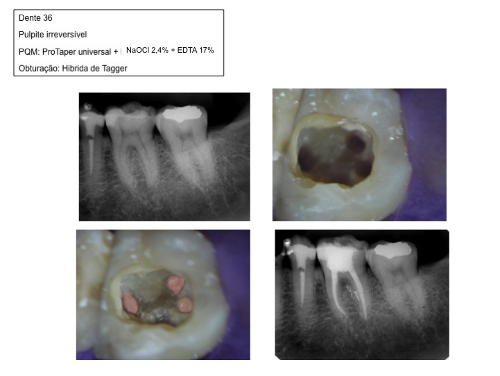 Davini - Endodontia e Microscopia Operatória: Tratamento endodôntico ...