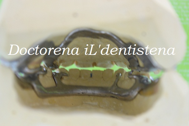 My Dental Diary: CO-Cr. RPD